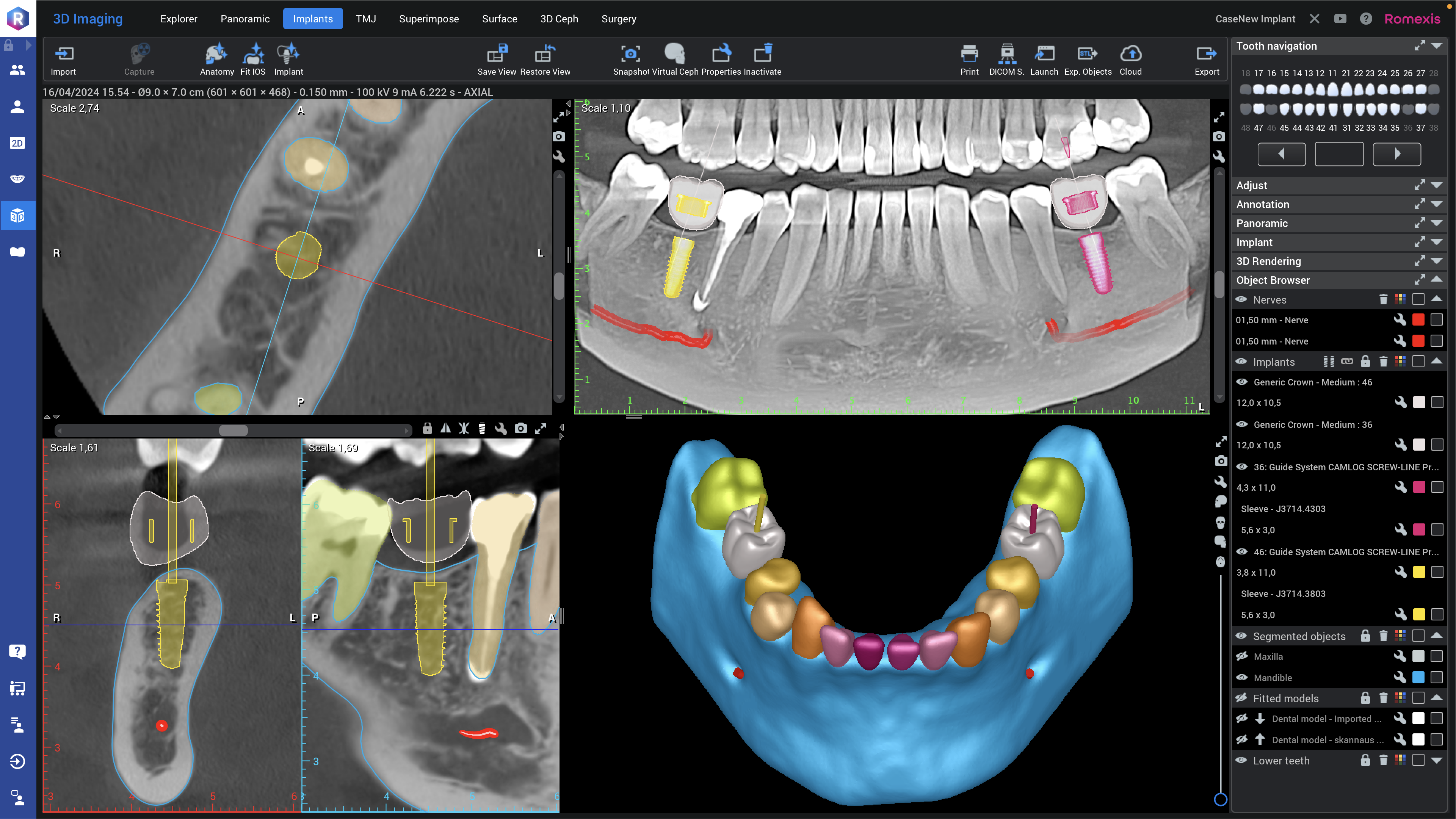 New software releases | Planmeca Romexis