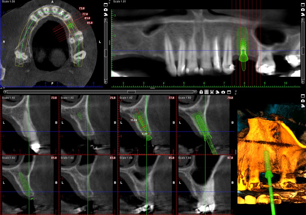 Planmeca ProMax 3D Plus – See beyond the dentition